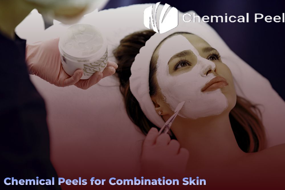 Chemical Peels For Combination Skin: Addressing All Your Needs ...