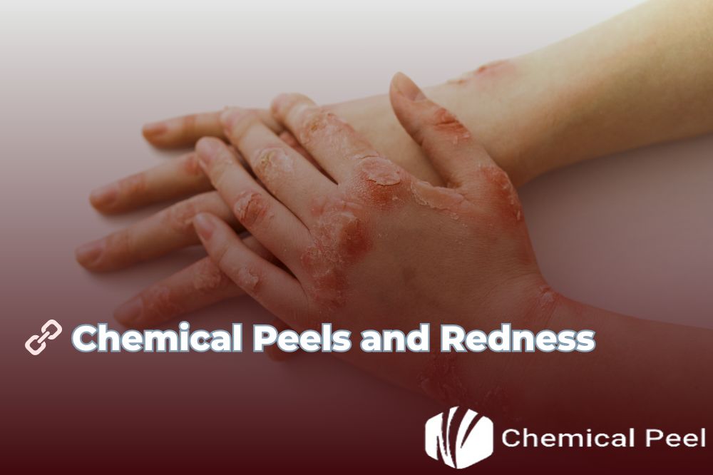 Chemical Peels And Redness: Minimizing Discomfort | Chemical Peel